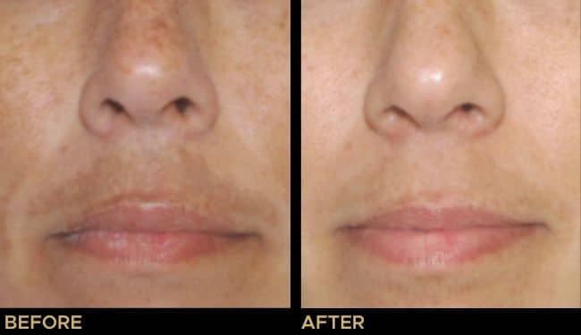 Before & After Gallery - Aesthetic Center of New Jersey