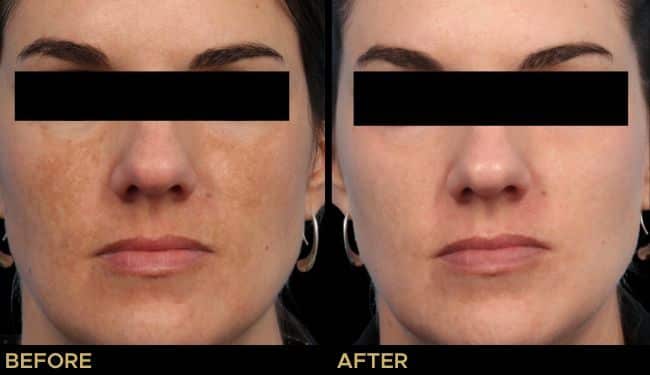 Before & After Gallery - Aesthetic Center of New Jersey